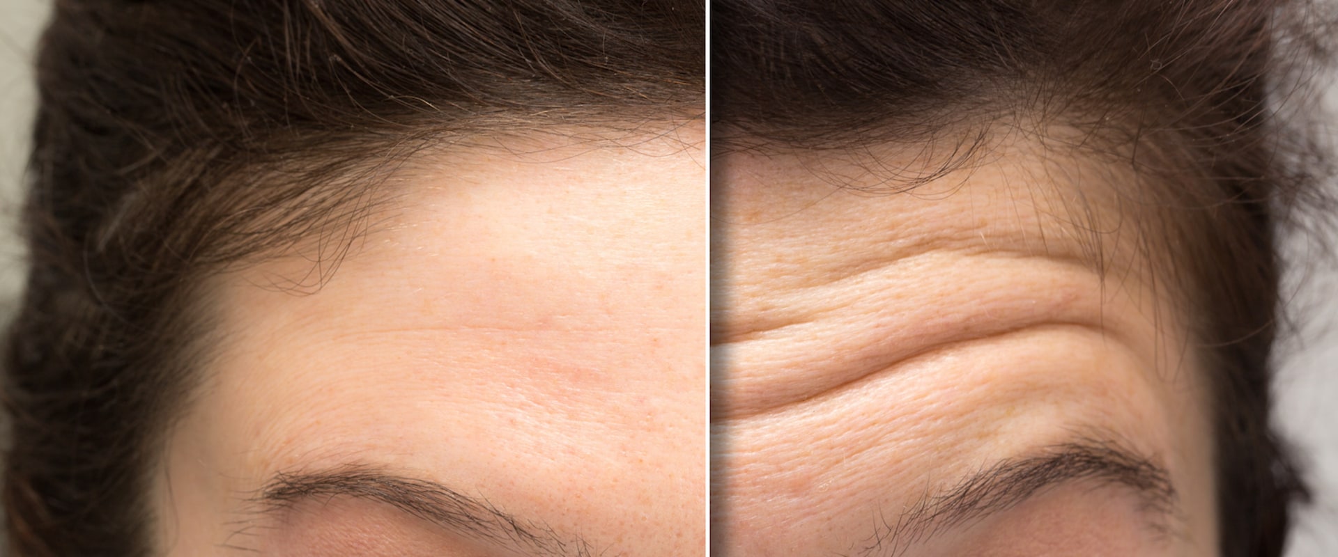 How Long Does Botox Last? Expert Advice on Maximizing Results