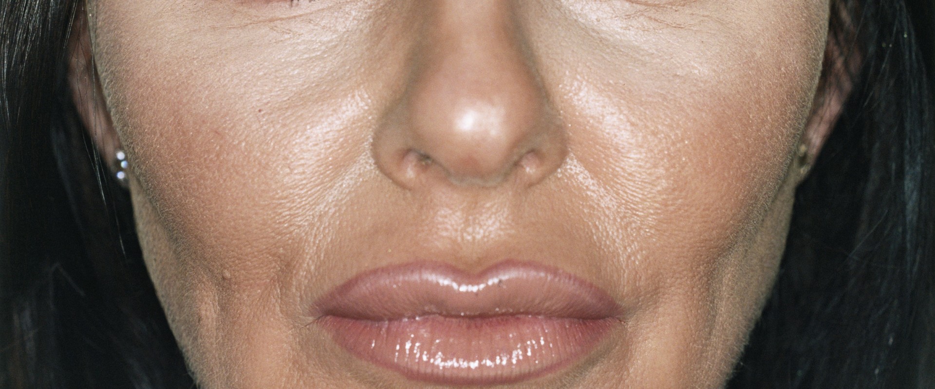 What Happens to Your Face When You Get Botox?