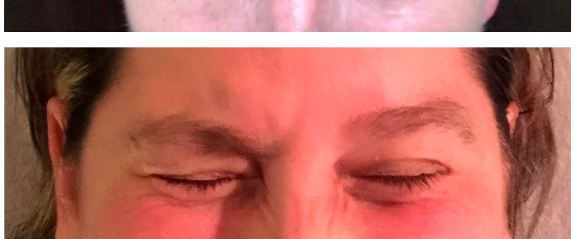 Is Botox Toxic in the Long Term? A Comprehensive Review